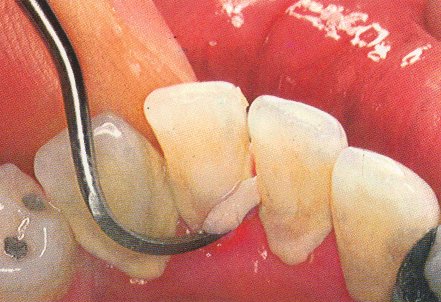 Teeth Cleaning